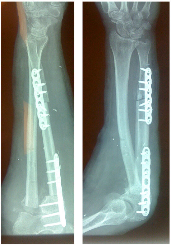 Outcomes of Free Vascularized Fibular Grafts in Treating Massive ...