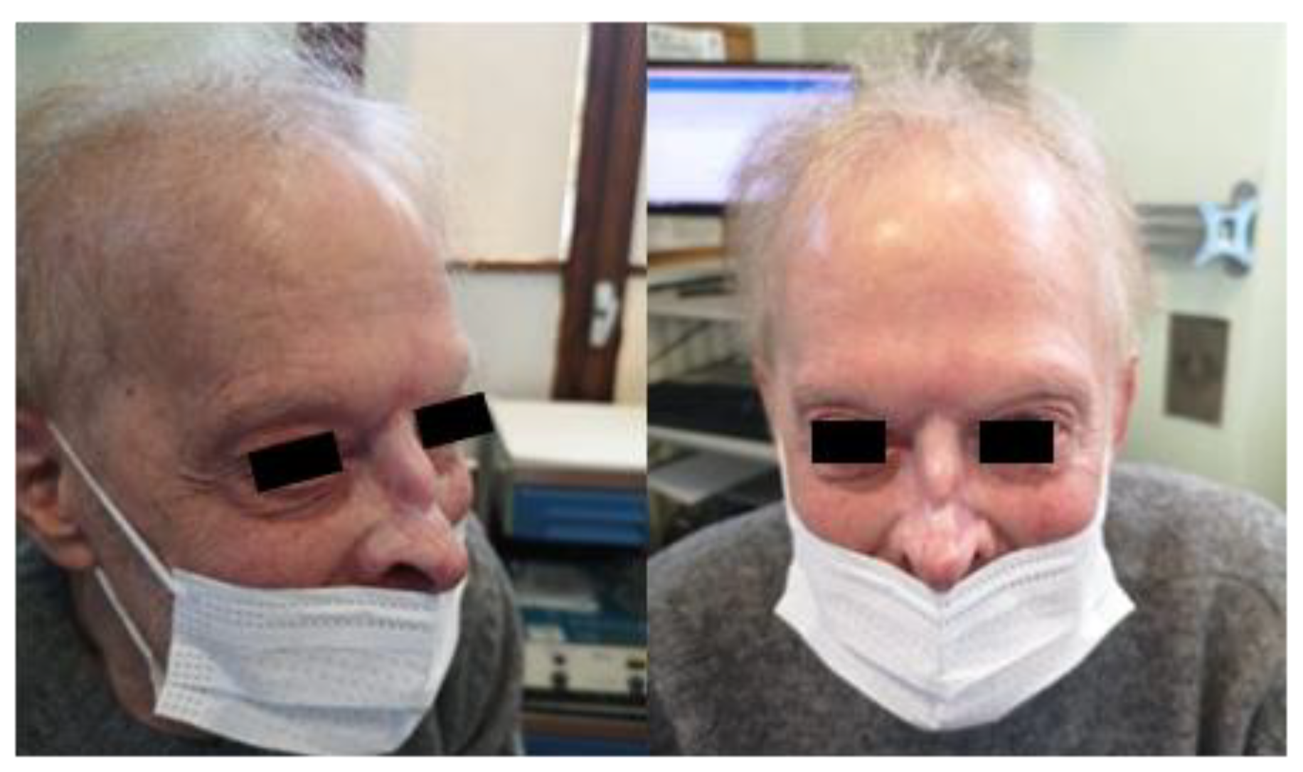 Electrochemotherapy Treatment in a Patient with an Extended Basal Cell ...