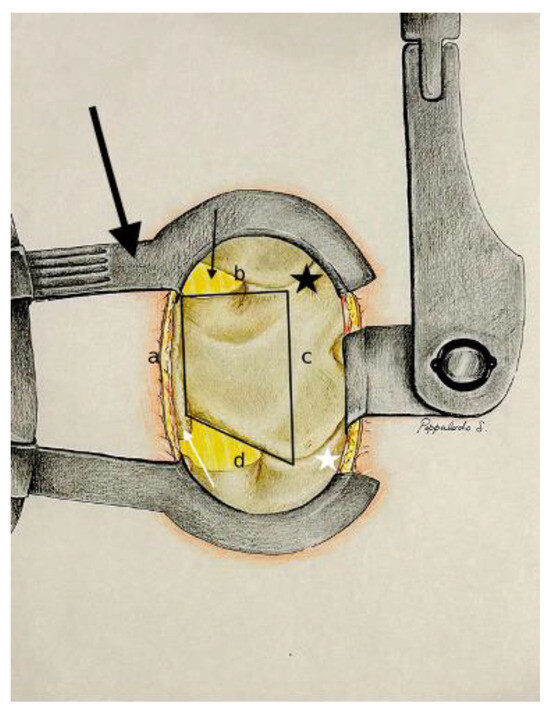 The 3-Steps Approach for Lumbar Stenosis with Anatomical Insights ...
