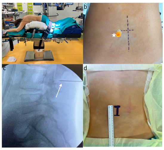 The 3-Steps Approach for Lumbar Stenosis with Anatomical Insights ...