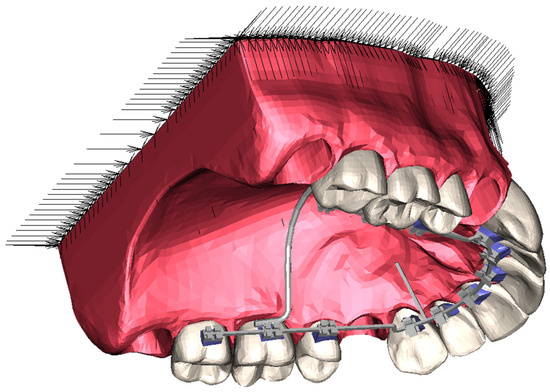 Numerical Simulation of Maxillary Anterior Teeth Retraction Utilizing ...