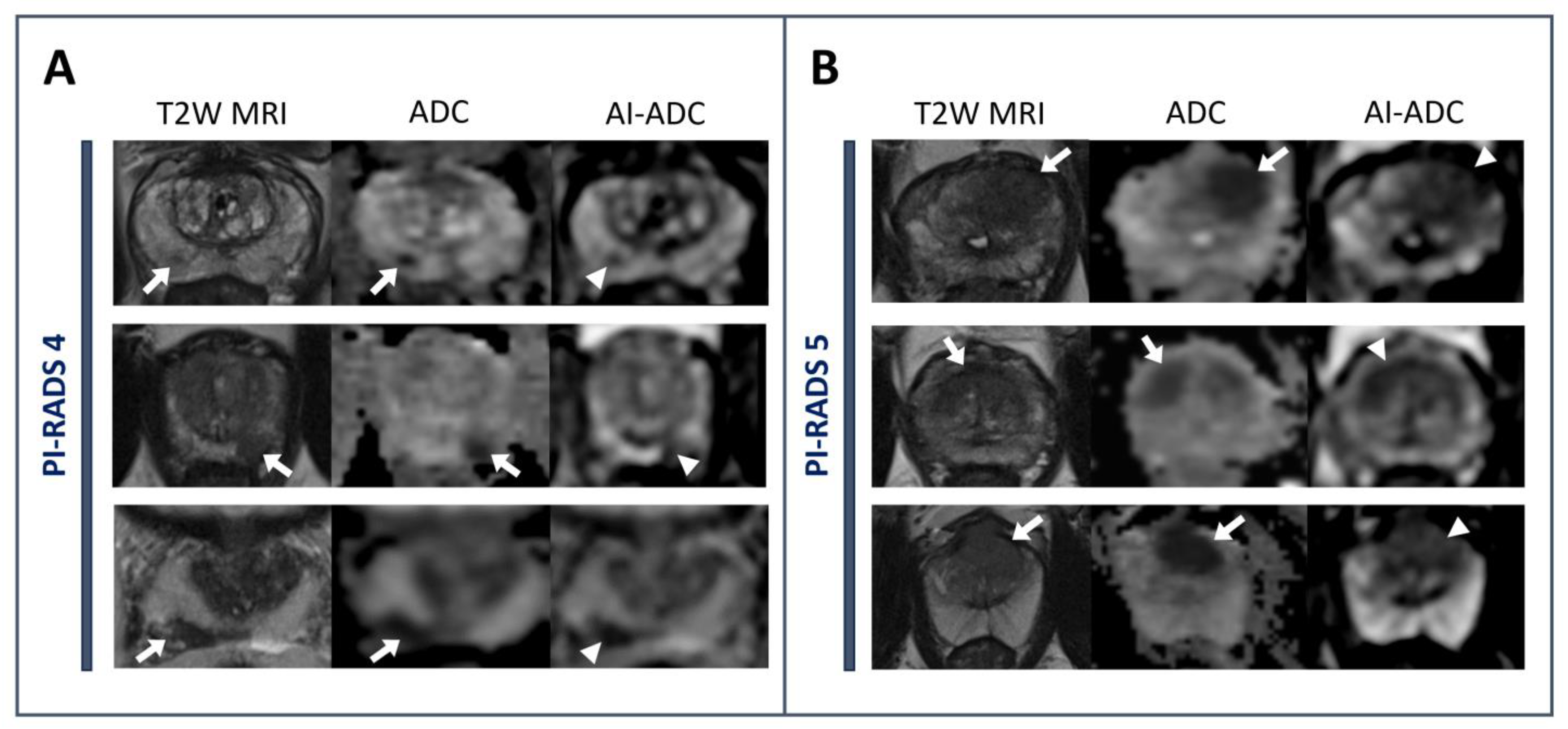 AI-ADC: Channel and Spatial Attention-Based Contrastive Learning to Generate ADC Maps from T2W ...