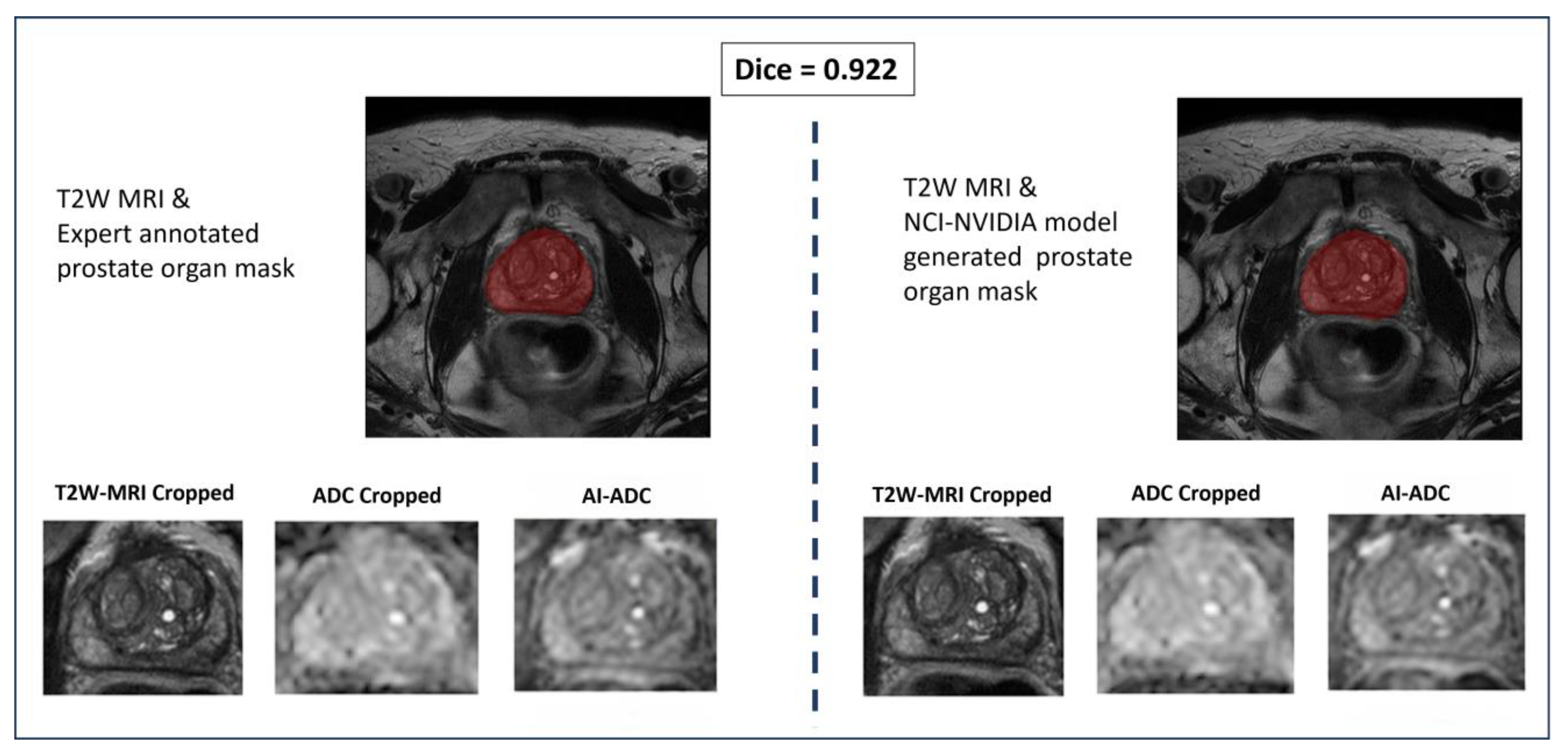 AI-ADC: Channel and Spatial Attention-Based Contrastive Learning to Generate ADC Maps from T2W ...
