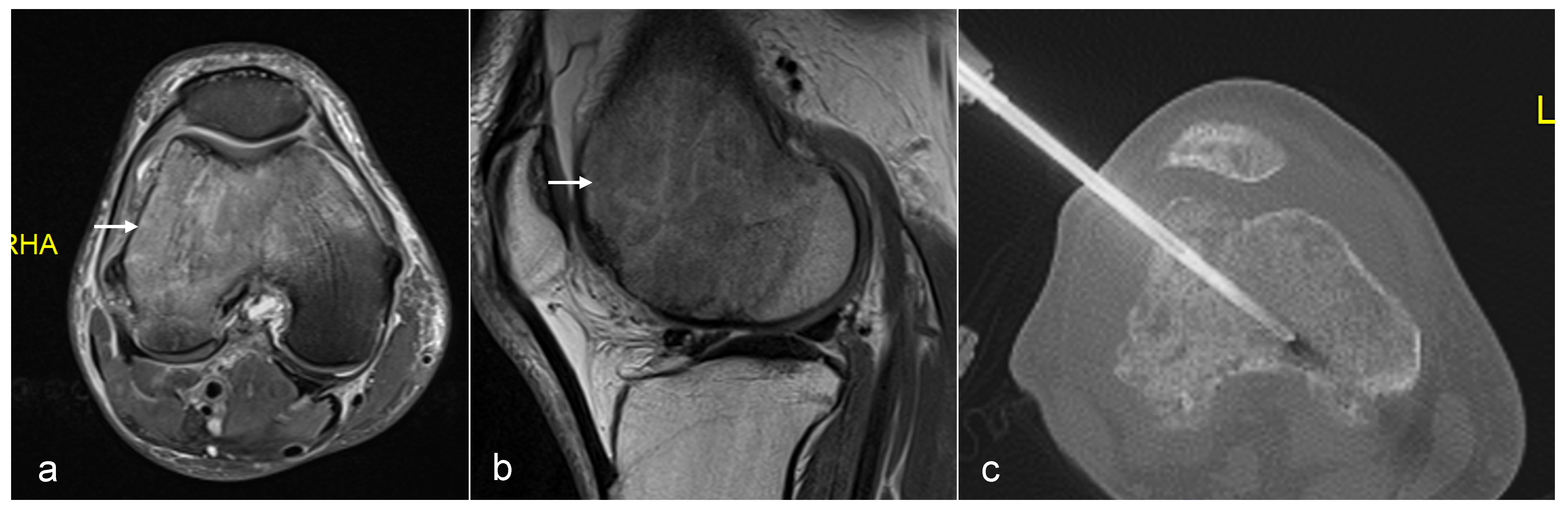Image-Guided Musculoskeletal Interventional Radiology in the ...