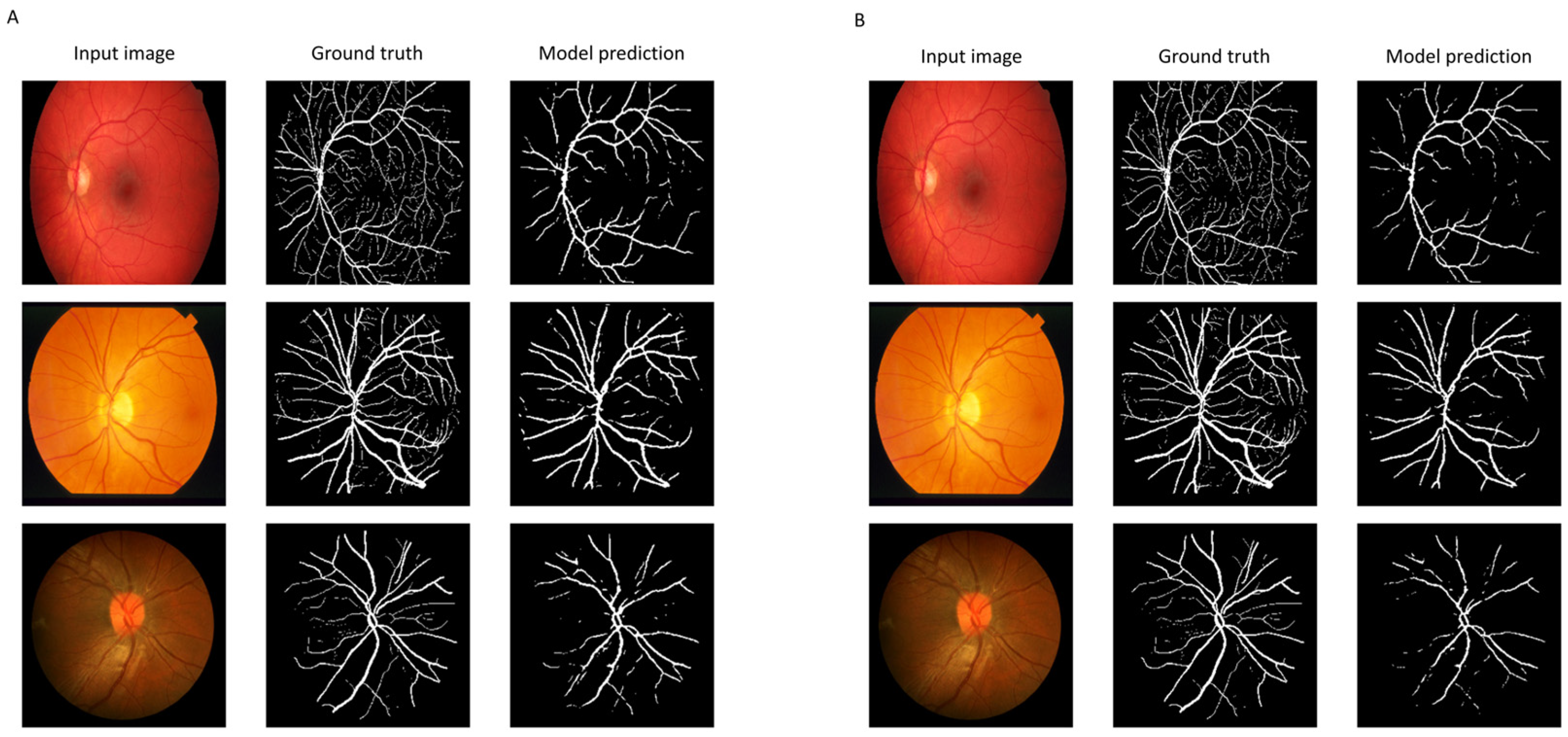 Intraoperative Augmented Reality for Vitreoretinal Surgery Using Edge ...
