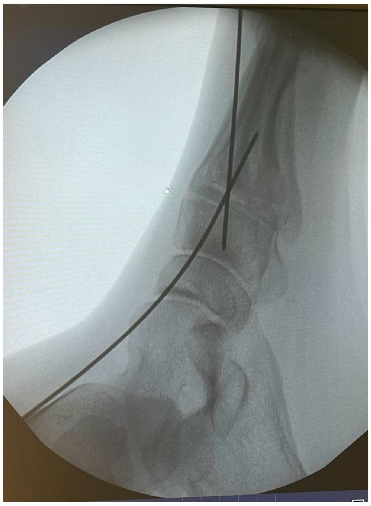 Minimally Invasive Lapidus Arthrodesis Associated with Distal Osteotomy ...