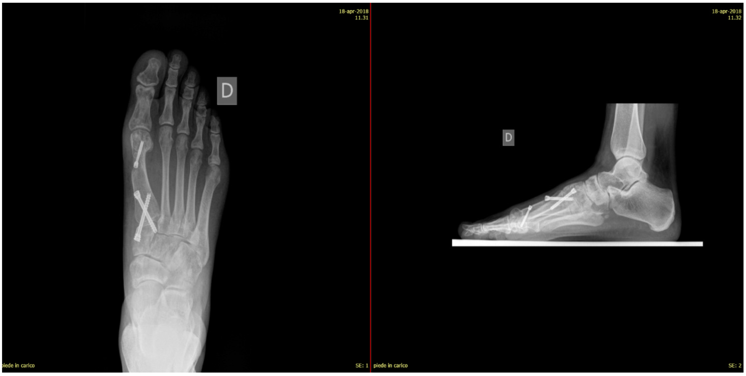 Minimally Invasive Lapidus Arthrodesis Associated with Distal Osteotomy ...