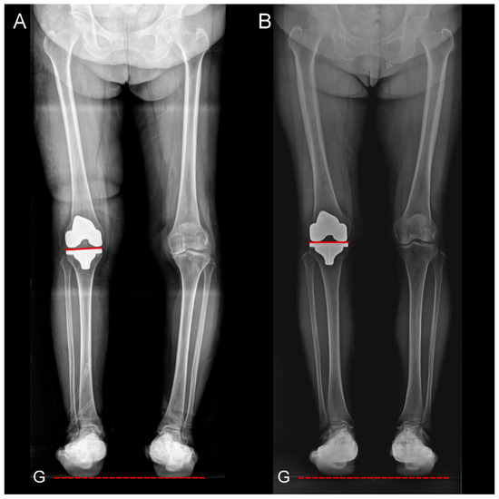 Comparison of Outcomes Between Functionally and Mechanically Aligned ...