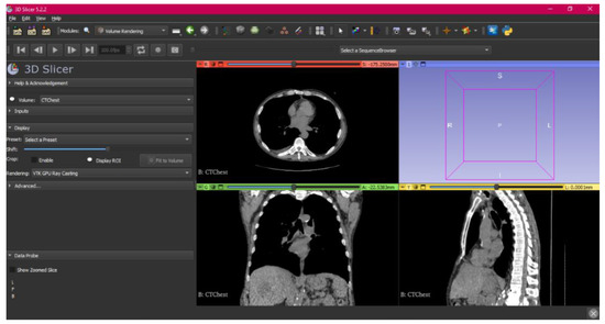 Protocol for Converting DICOM Files to STL Models Using 3D Slicer and Ultimaker Cura