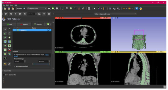 Protocol for Converting DICOM Files to STL Models Using 3D Slicer and ...