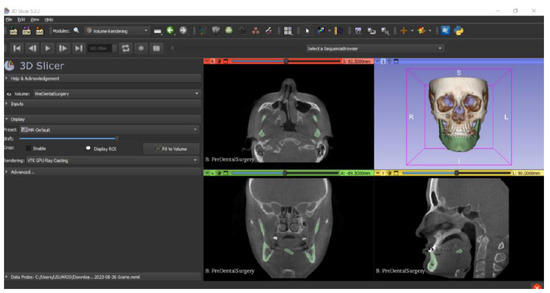 Protocol for Converting DICOM Files to STL Models Using 3D Slicer and Ultimaker Cura