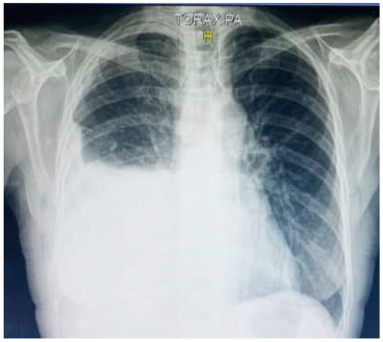 Primary Pleural Lymphoma in an Immune-Competent Patient: A Diagnostic ...