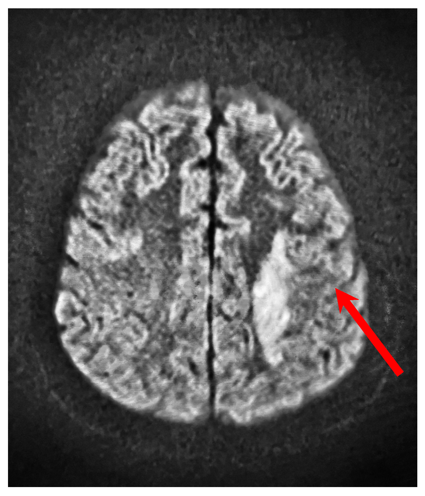 Thromboembolic Risk and High Prothrombotic Factors in Childhood Acute ...