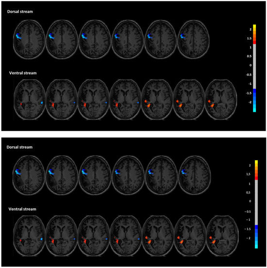 Personalized Language Training and Bi-Hemispheric tDCS Improve Language ...