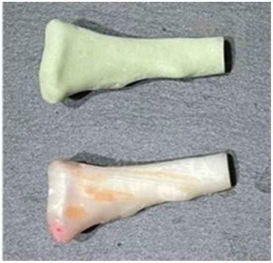 3D Printing and Virtual Surgical Planning in Craniofacial and Thoracic ...