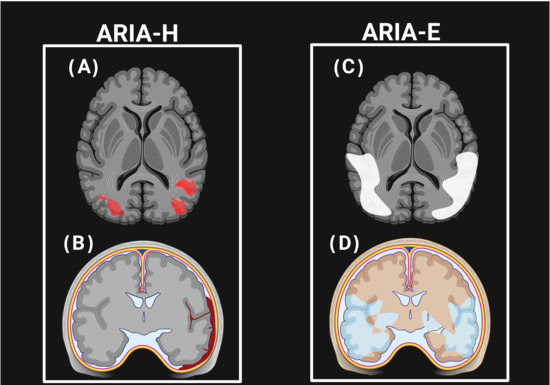 Anti-Amyloid Monoclonal Antibodies for Alzheimer’s Disease: Evidence ...