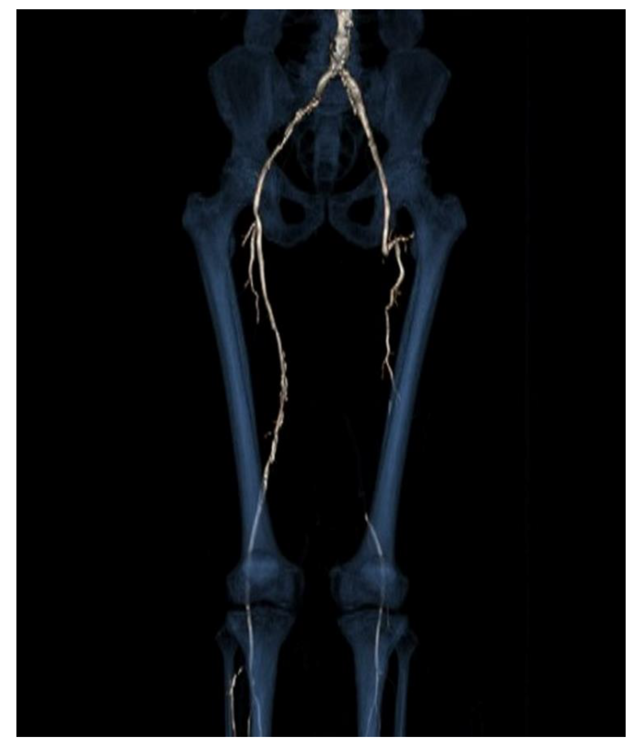 Stent-Graft Repair of Concomitant Occlusion and Anastomotic ...