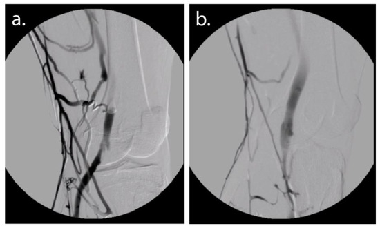 Alternative Approaches to Osteoarthritis-Related Knee Pain: Transvenous ...