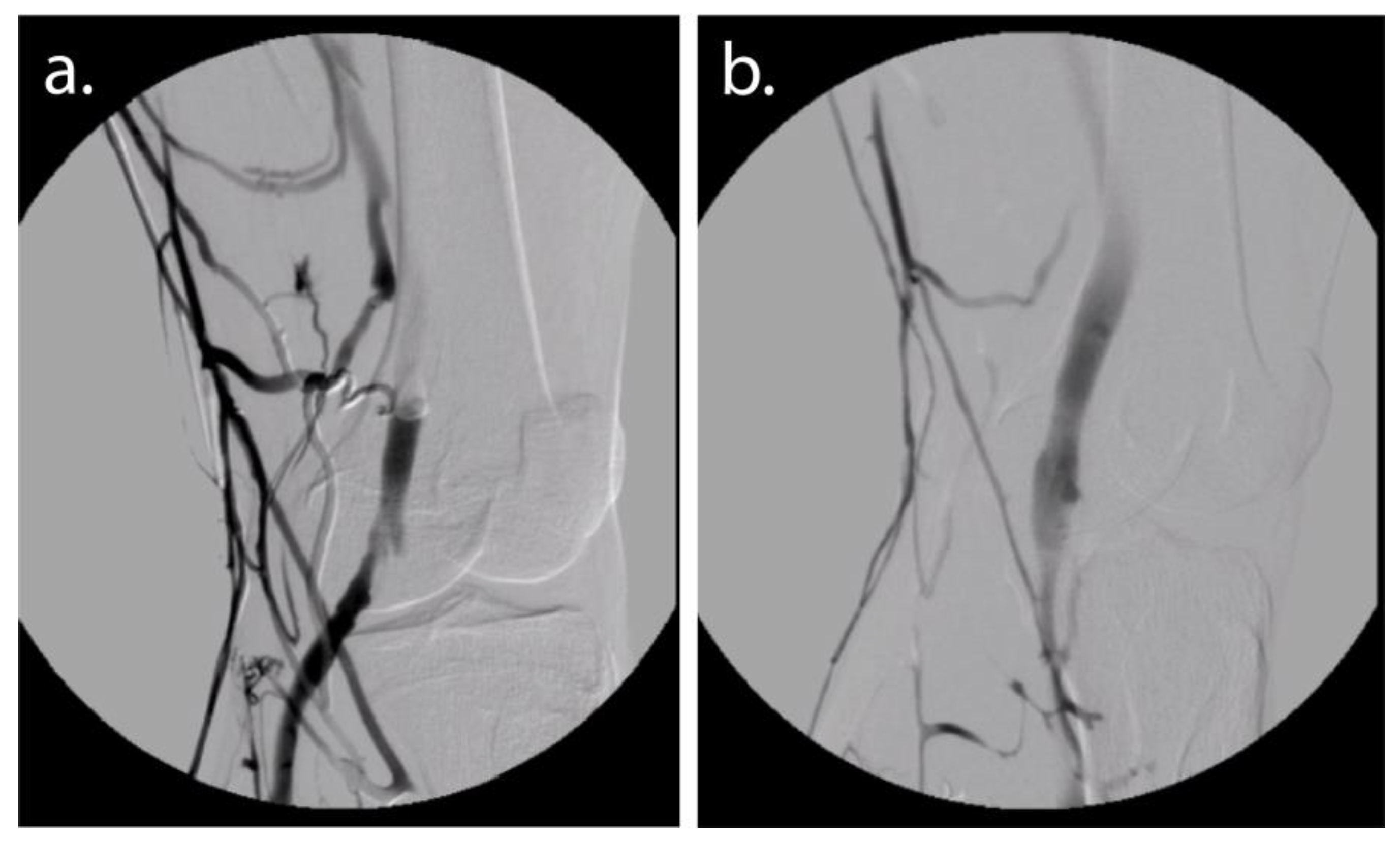 Alternative Approaches to Osteoarthritis-Related Knee Pain: Transvenous ...