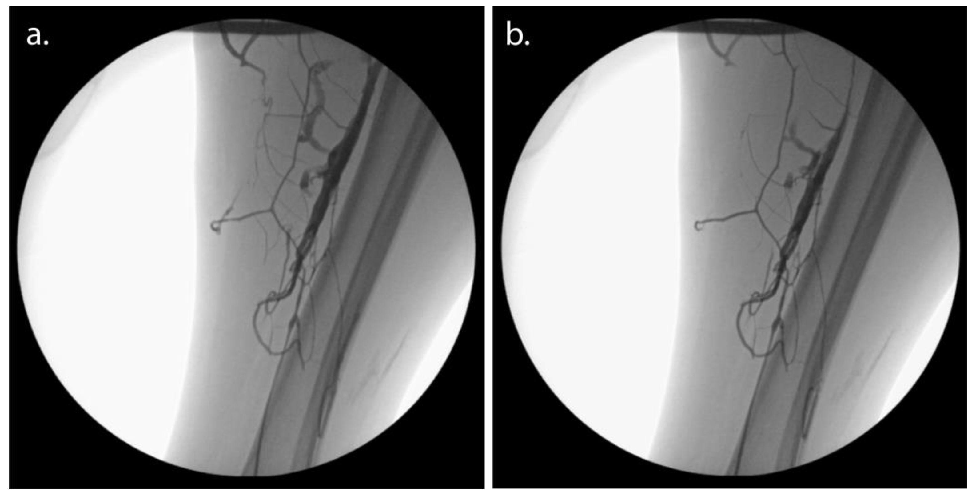 Alternative Approaches to Osteoarthritis-Related Knee Pain: Transvenous ...