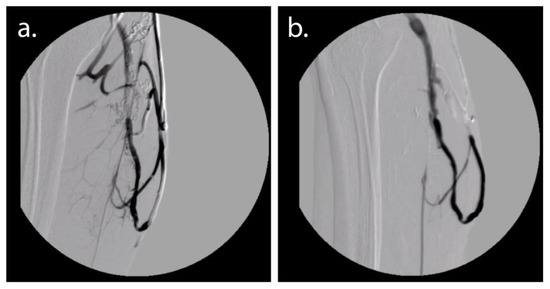 Alternative Approaches to Osteoarthritis-Related Knee Pain: Transvenous ...