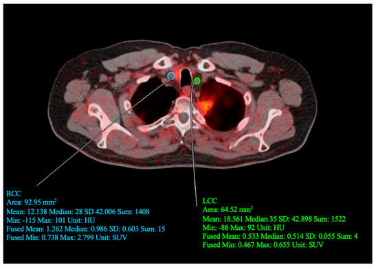 The Emerging Role of NaF-PET/CT in Detecting Vascular ...