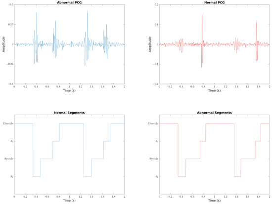 Abnormal Heart Sound Classification and Model Interpretability: A Transfer Learning Approach ...
