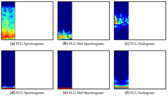 Abnormal Heart Sound Classification and Model Interpretability: A ...