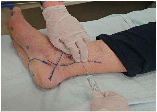 Dellon Decompression Using WALANT: A Safe and Effective Approach for ...