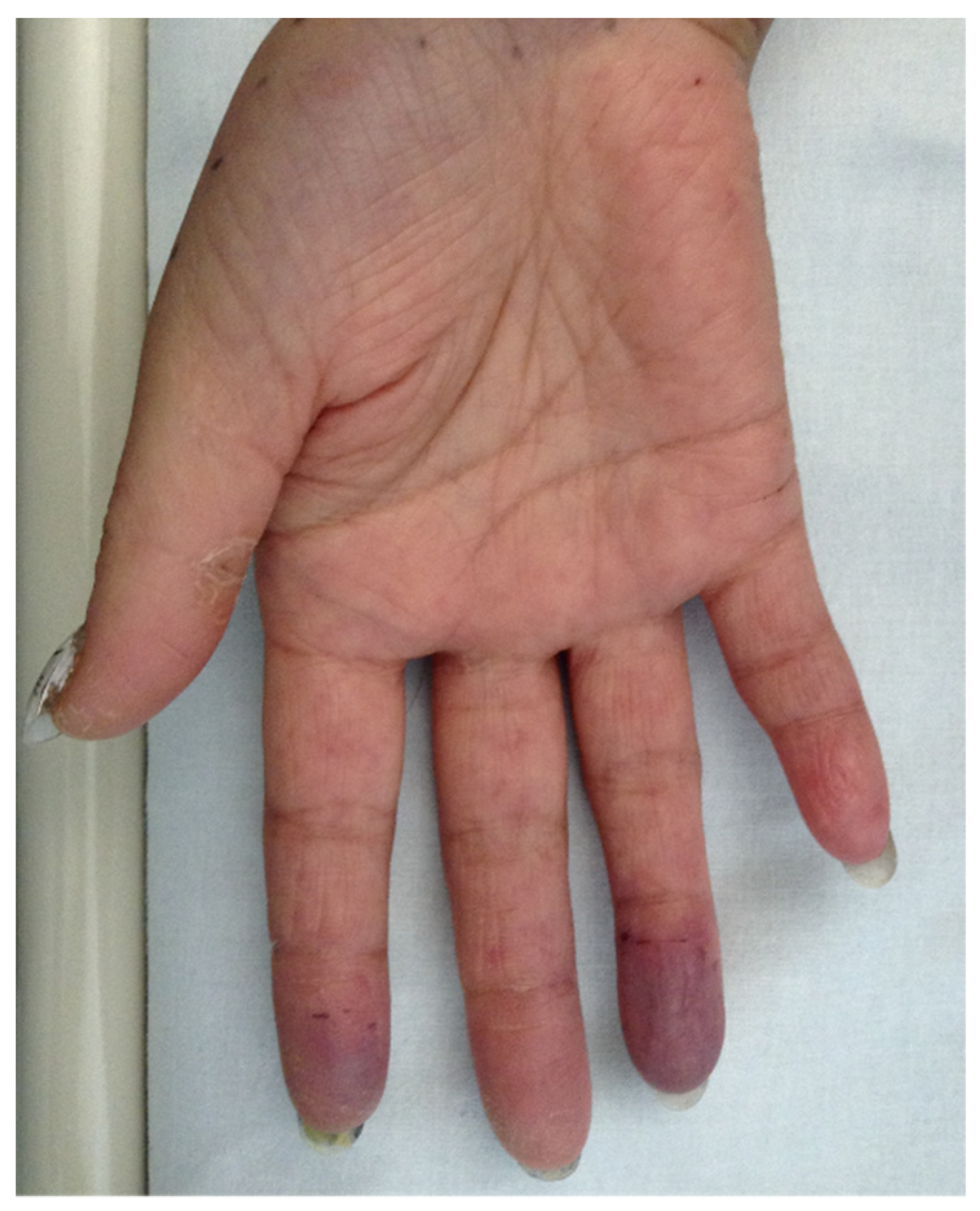 A Case of Brachial Artery Thrombosis Caused by Massage of an Occluded ...