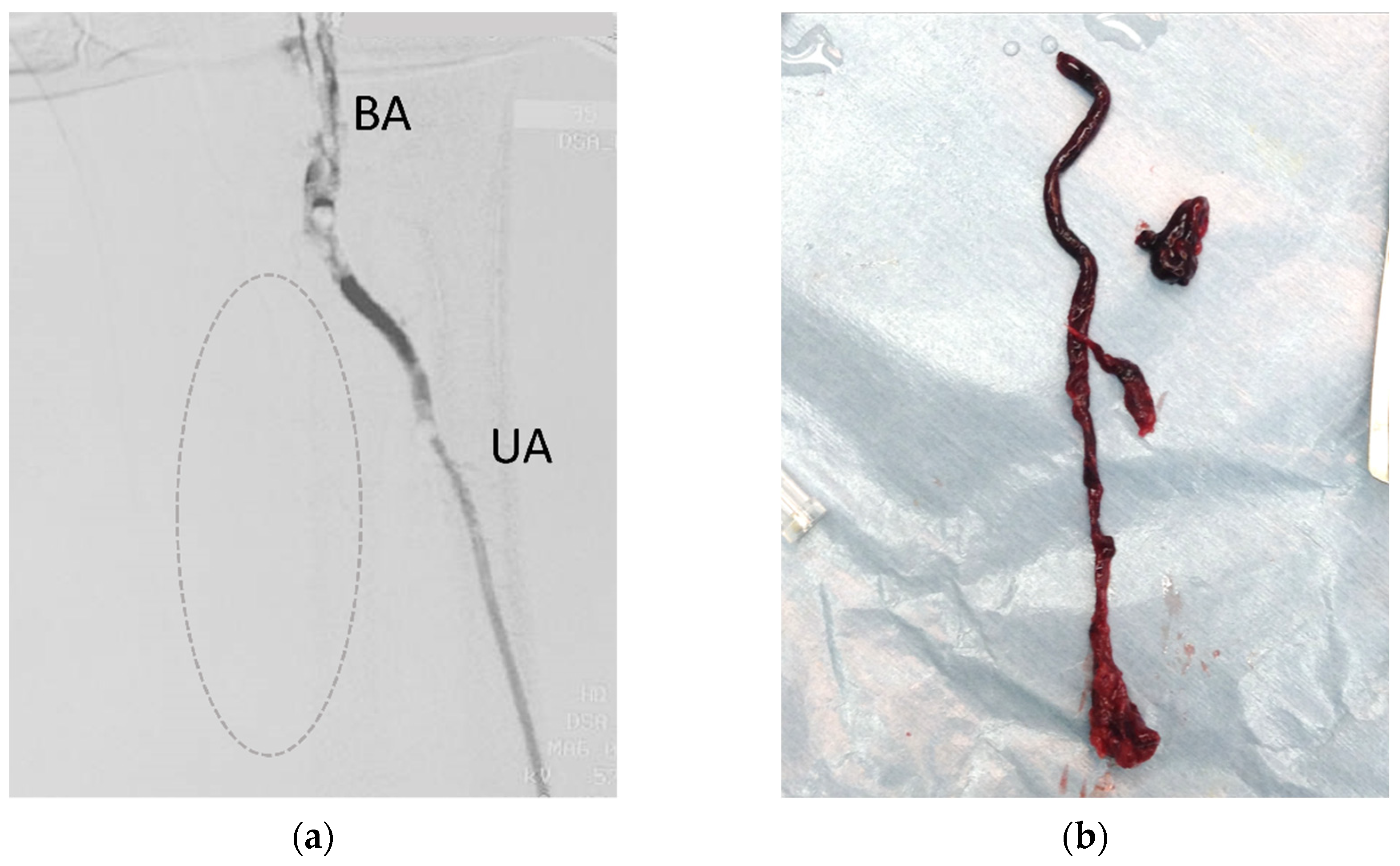 A Case of Brachial Artery Thrombosis Caused by Massage of an Occluded ...