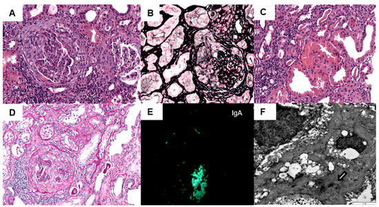 Remission of Proteinuria in a Patient Affected by Crescentic IgA ...
