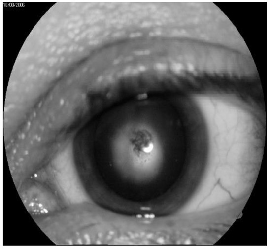 Radiation-Induced Cerebro-Ophthalmic Effects in Humans
