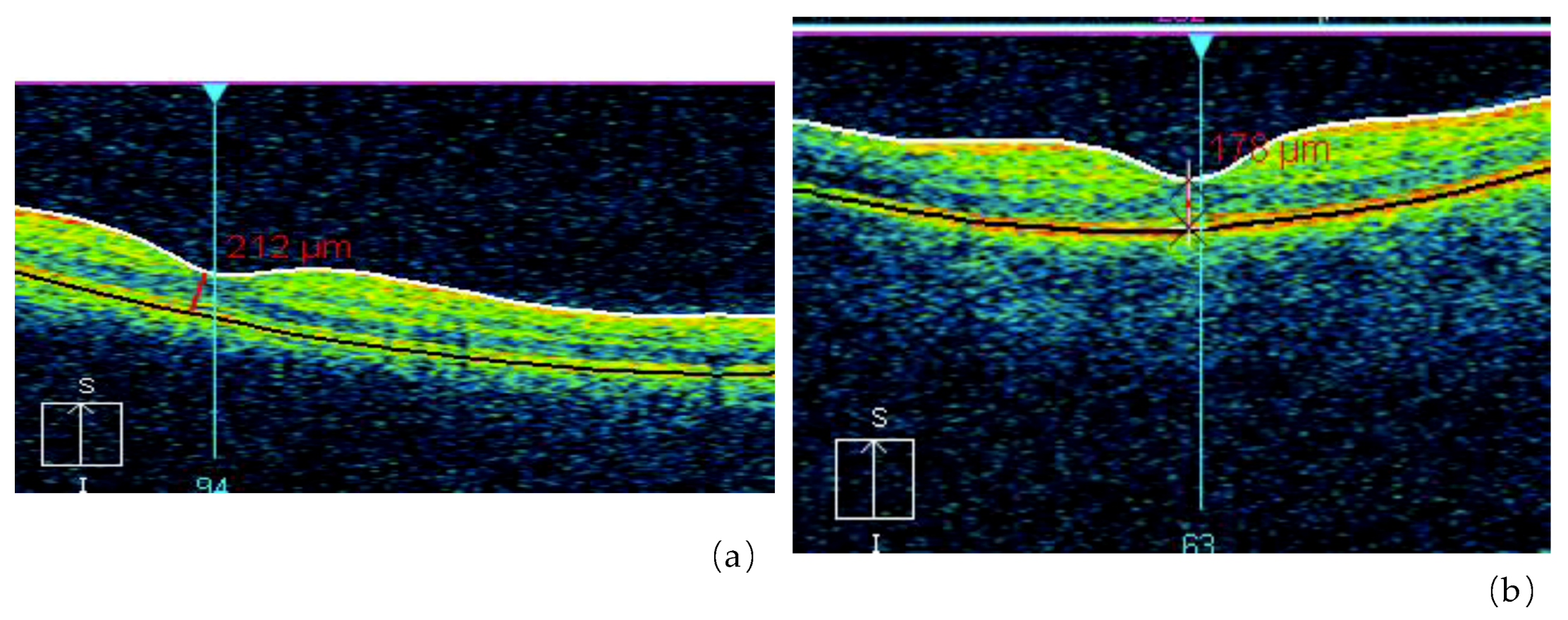 Radiation-Induced Cerebro-Ophthalmic Effects in Humans