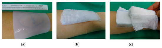 The Impact of a Nanocellulose-Based Wound Dressing in the Management of ...