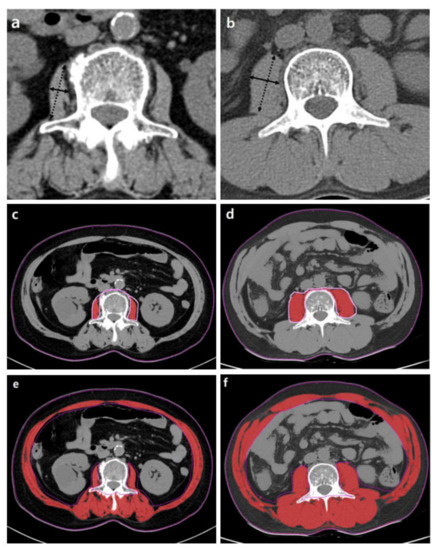 Radiologic Definition of Sarcopenia in Chronic Liver Disease