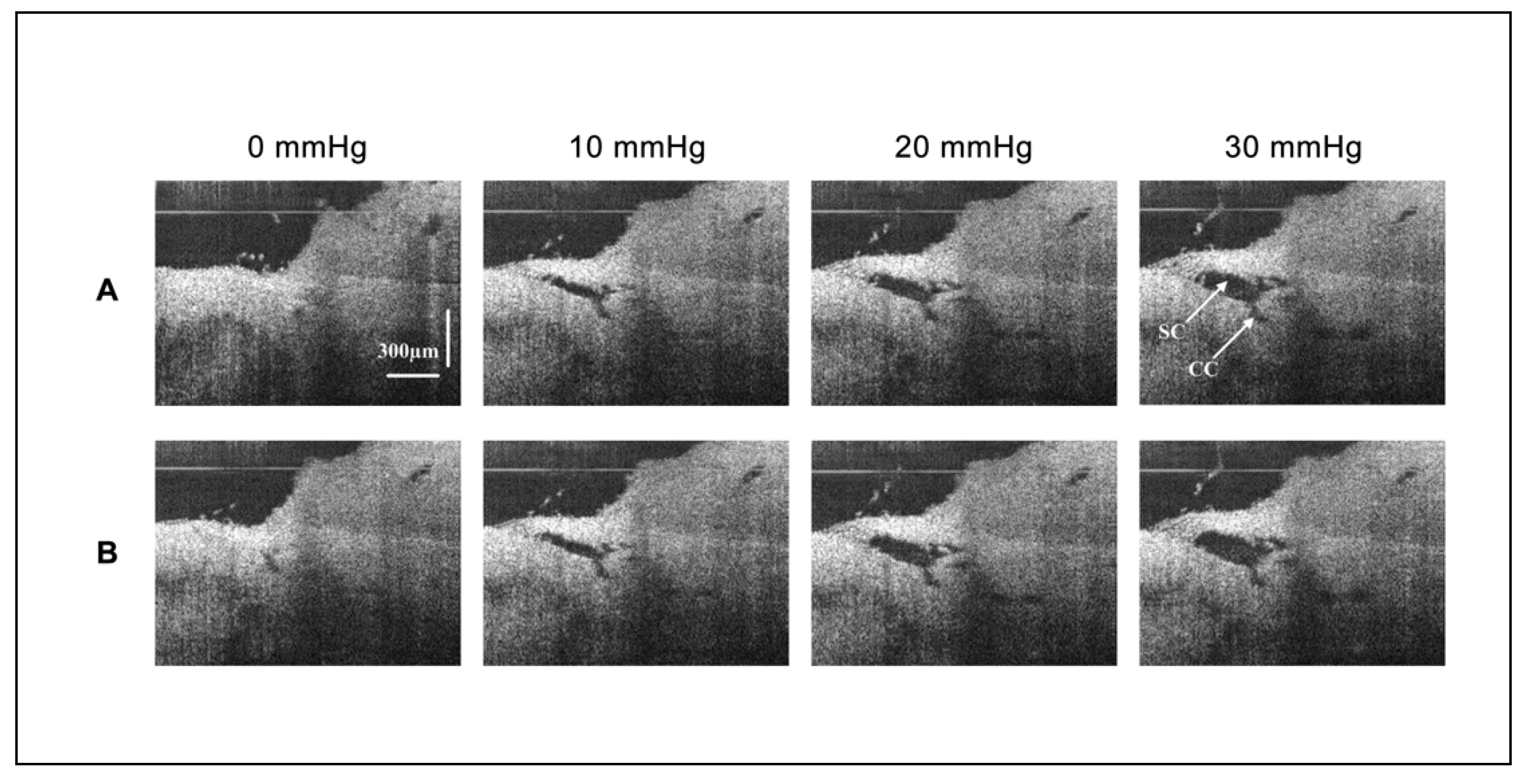 Effects of Schlemm’s Canal Expansion: Biomechanics and MIGS Implications