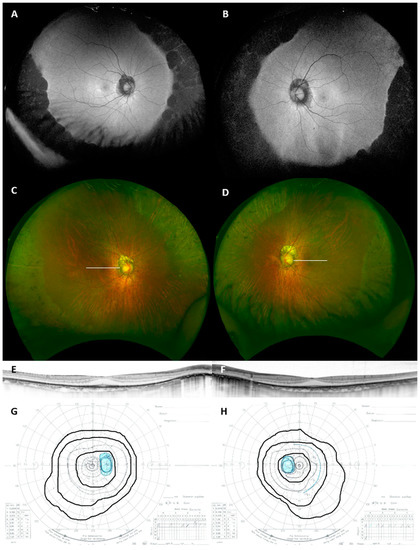 Clinical Characteristics, Differential Diagnosis and Genetic Analysis ...