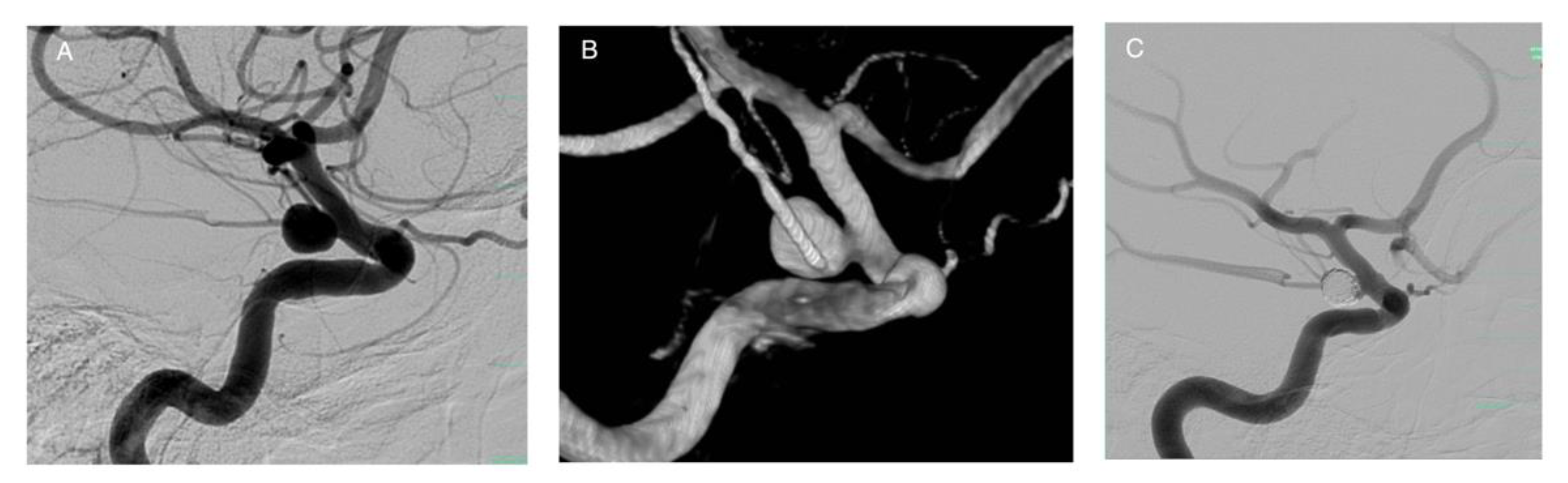 Life Free Full Text Endovascular Treatment Of Intracranial Aneurysms