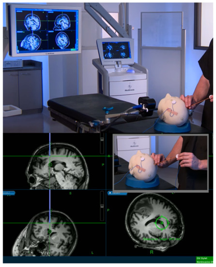 Neurosurgical CSF Diversion in Idiopathic Intracranial Hypertension: A ...