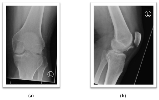 Reconstruction of Large Osteochondral Lesions in the Knee: Focus on ...