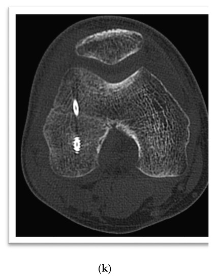 Life | Special Issue : Focal Chondral Defects