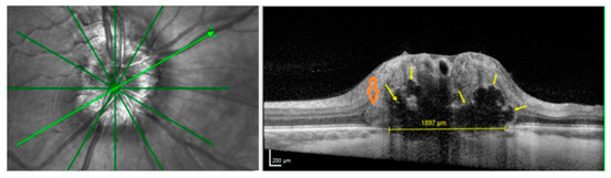 OCT Based Interpretation of the Optic Nerve Head Anatomy and Prevalence ...