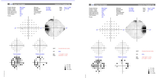 Paediatric Idiopathic Intracranial Hypertension (IIH)—A Review