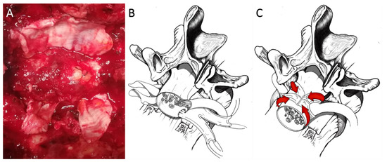 Anterior Dural Tear in Thoracic and Lumbar Spinal Fractures: Single ...