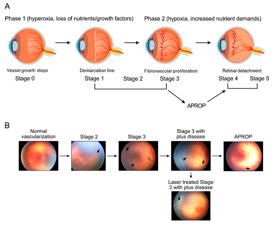 Life | Free Full-Text | Metabolism in Retinopathy of Prematurity