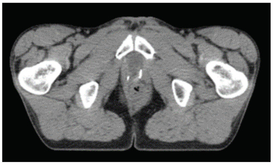 Prostate Cancer Aggressiveness Prediction Using CT Images