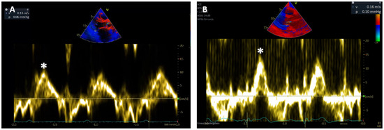 Diagnostic and Prognostic Value of a TDI-Derived Systolic Wall Motion ...