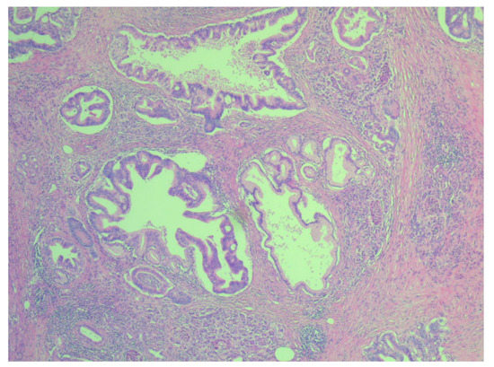Protective or Risk Factors for Postoperative Pancreatic Fistulas in ...