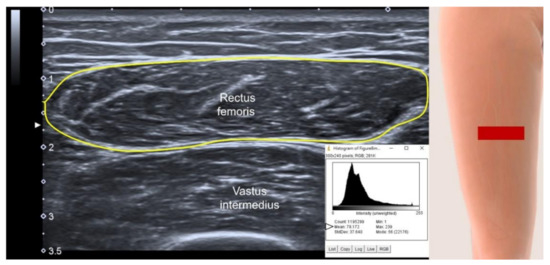Ultrasound Imaging for the Diagnosis and Evaluation of Sarcopenia: An ...